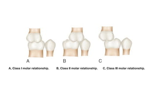 Occlusion and Malocclusion for Dental Assistants.pptx