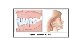 Occlusion and Malocclusion for Dental Assistants.pptx