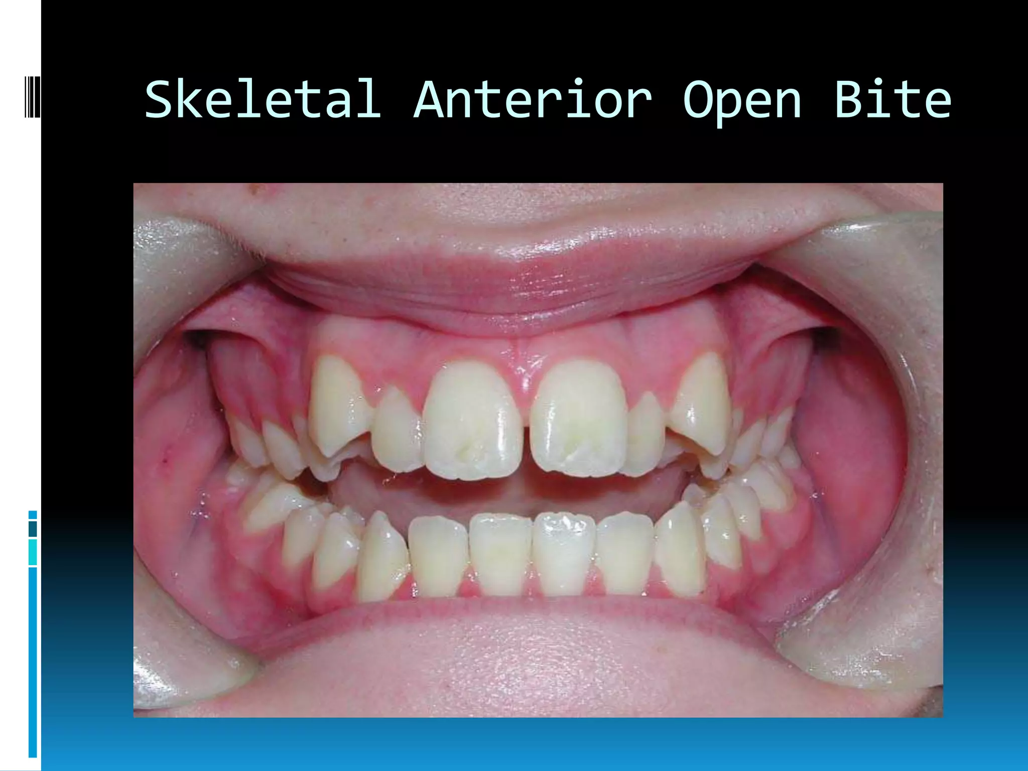 Occlusion and tmd | PPTX