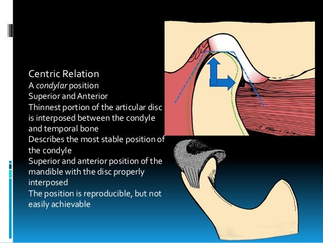 Occlusion and tmd