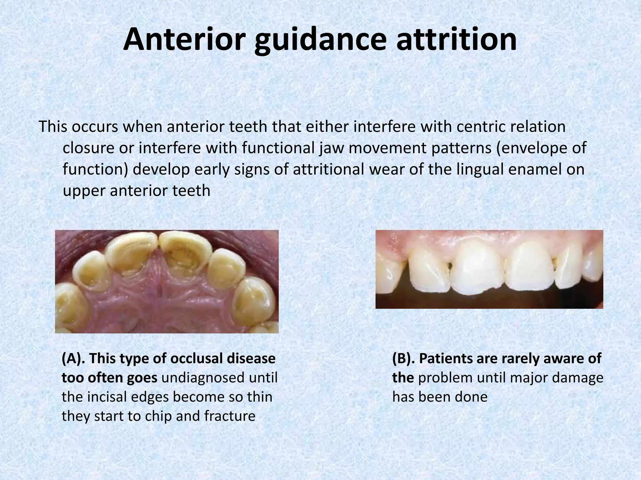 Occlusion diseases | PPTX