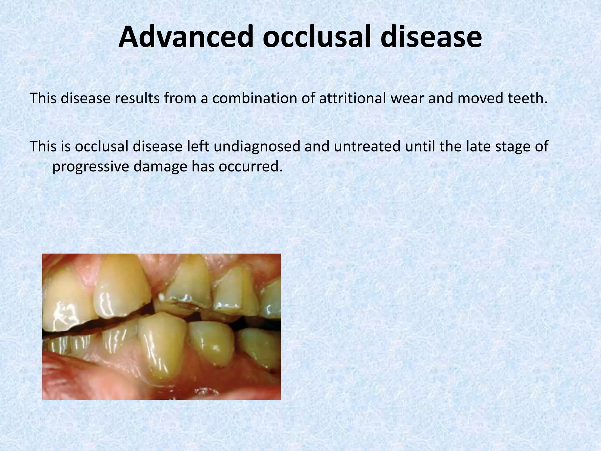 Occlusion diseases | PPTX