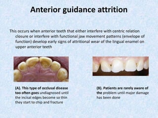 Occlusion diseases | PPTX