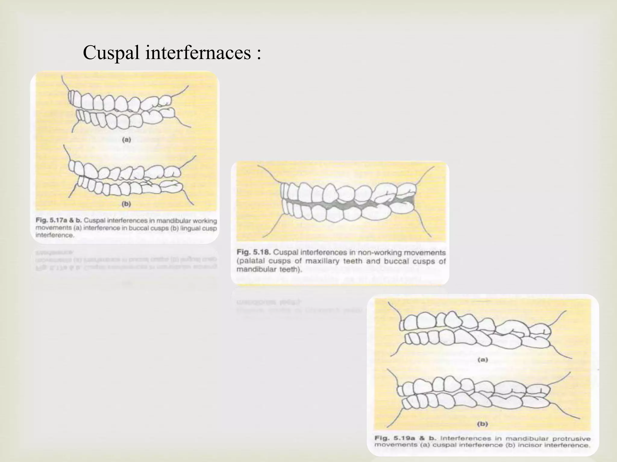 Occlusion in conservative dentistry | PPTX