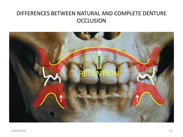 OCCLUSION IN COMPLETE DENTURES.pptx | Dental Health | Diseases and ...