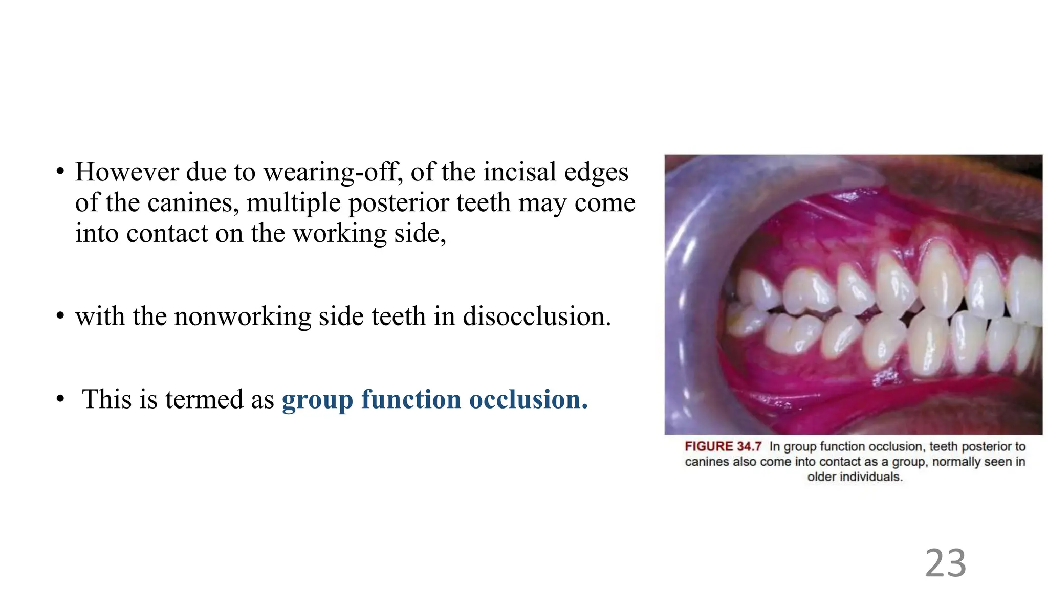 OCCLUSION IN FPD prosthodontics seminar final year | PPTX