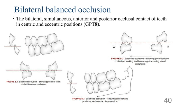 OCCLUSION IN FPD prosthodontics seminar final year | PPTX | Dental ...