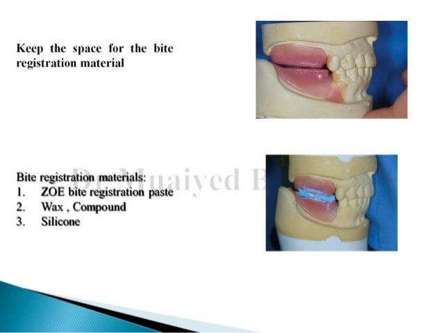 Occlusion in removable partial denture clinical 2014-9