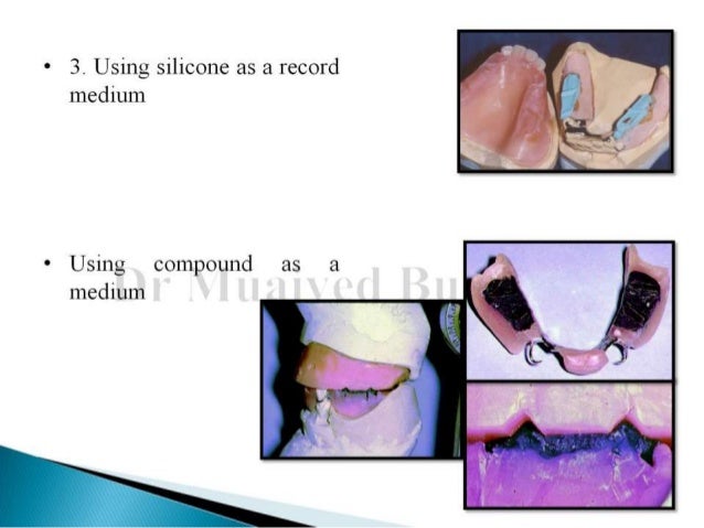 Clinical Performance Of Removable Partial Dentures A