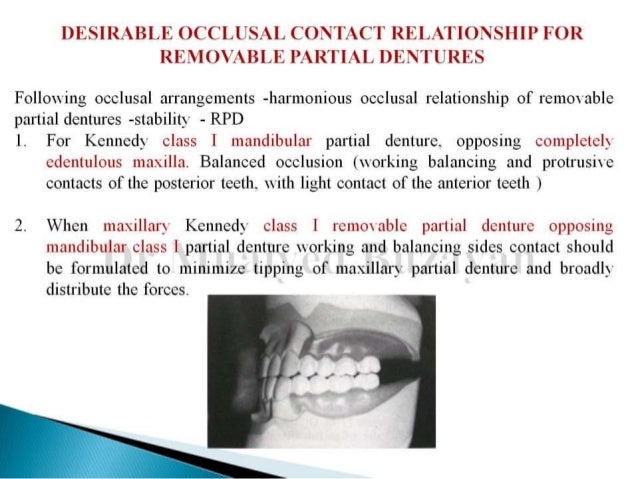 Clinical Performance Of Removable Partial Dentures A