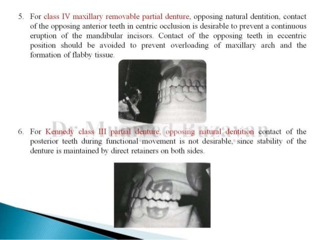 Clinical Performance Of Removable Partial Dentures A