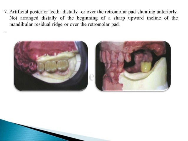 Clinical Performance Of Removable Partial Dentures A