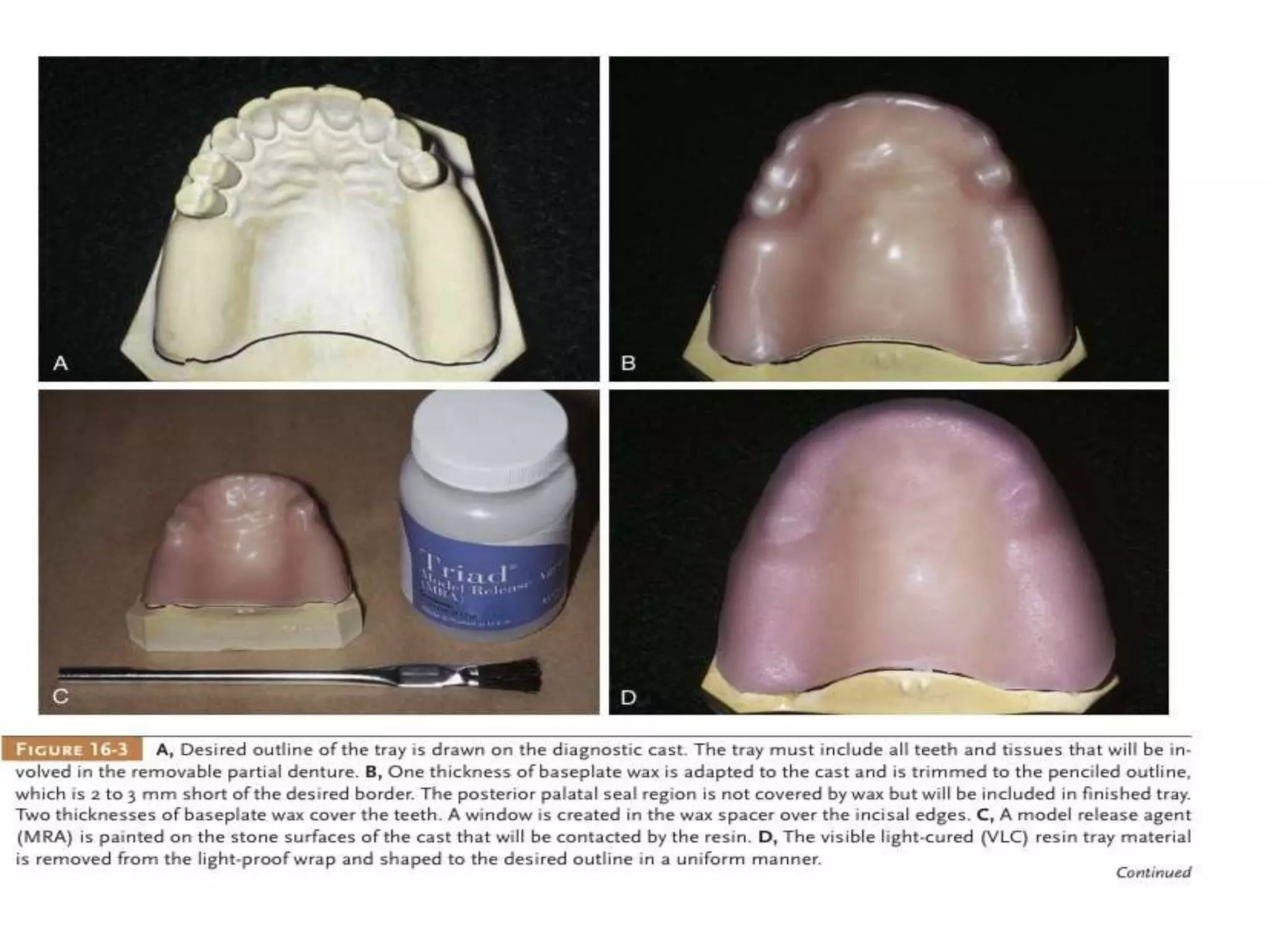 Occlusion in removal partial denture | PPT