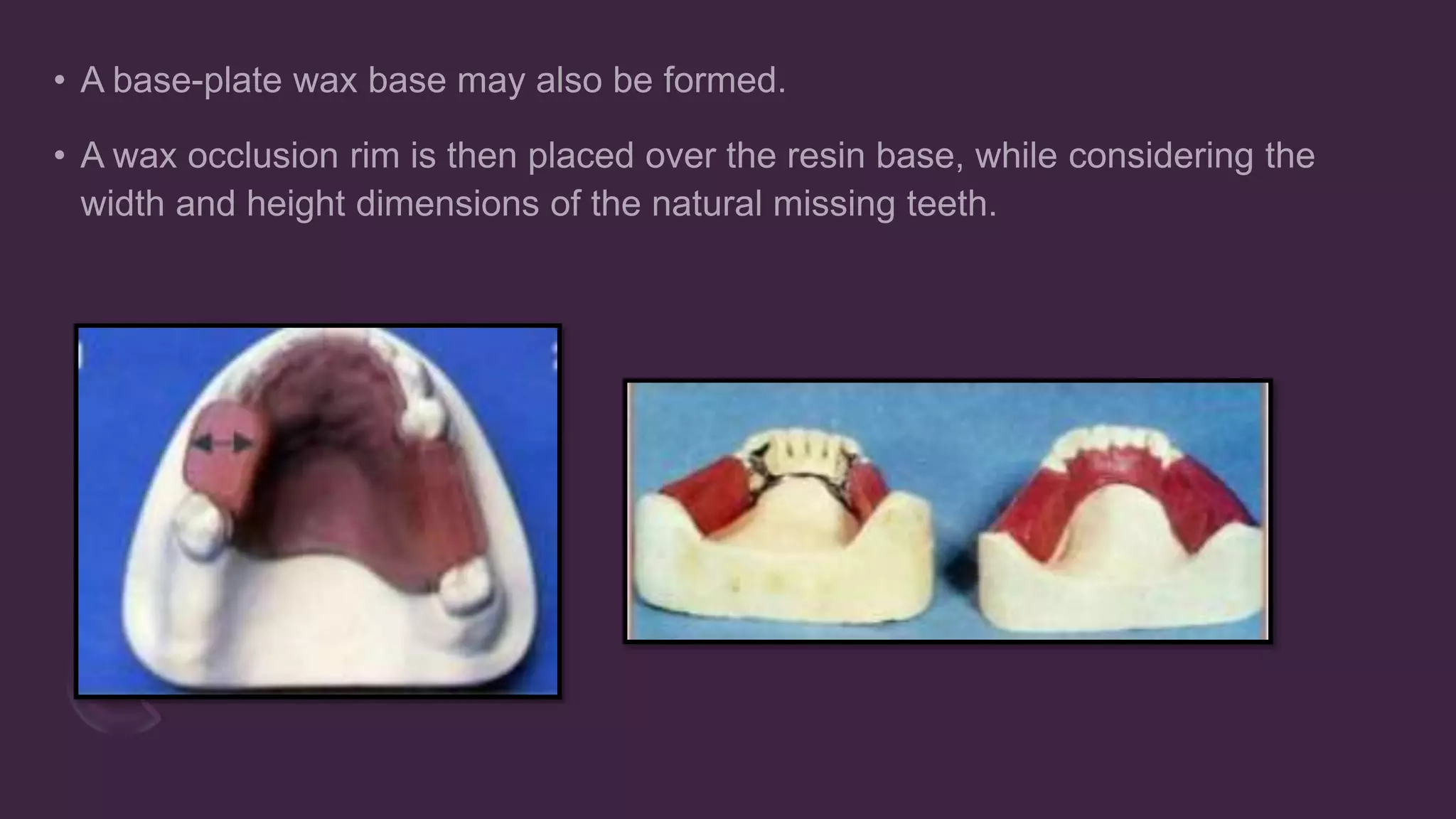 Occlusal Relationship in Removable partial denture | PPTX