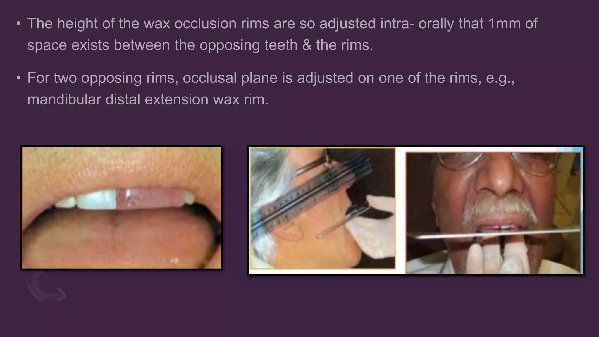 Occlusal Relationship in Removable partial denture | PPTX