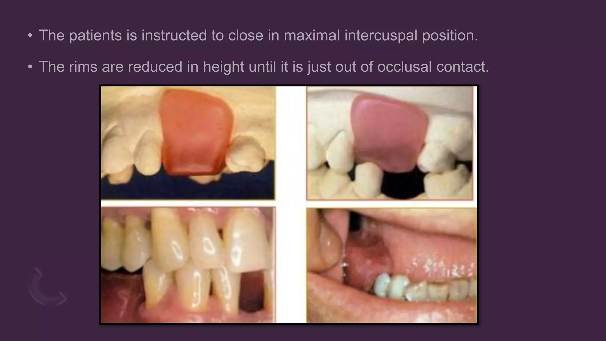 Occlusal Relationship in Removable partial denture | PPTX