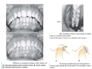 OCCLUSION | PPTX