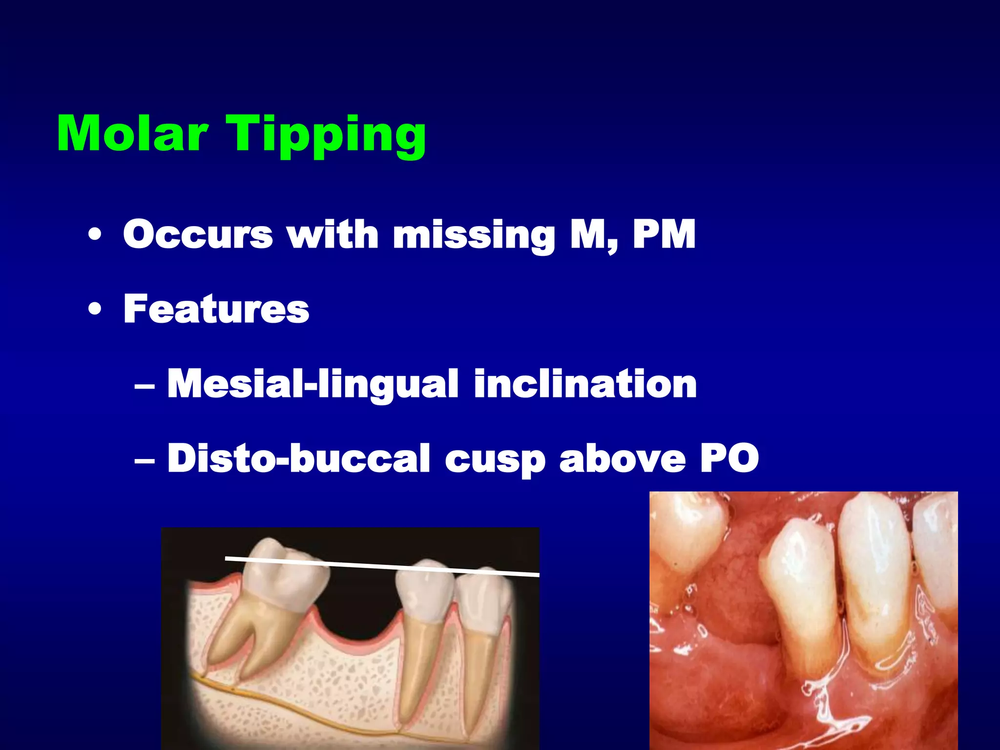 Occlusion of single denture (Management of Maxillary and Mandibular ...