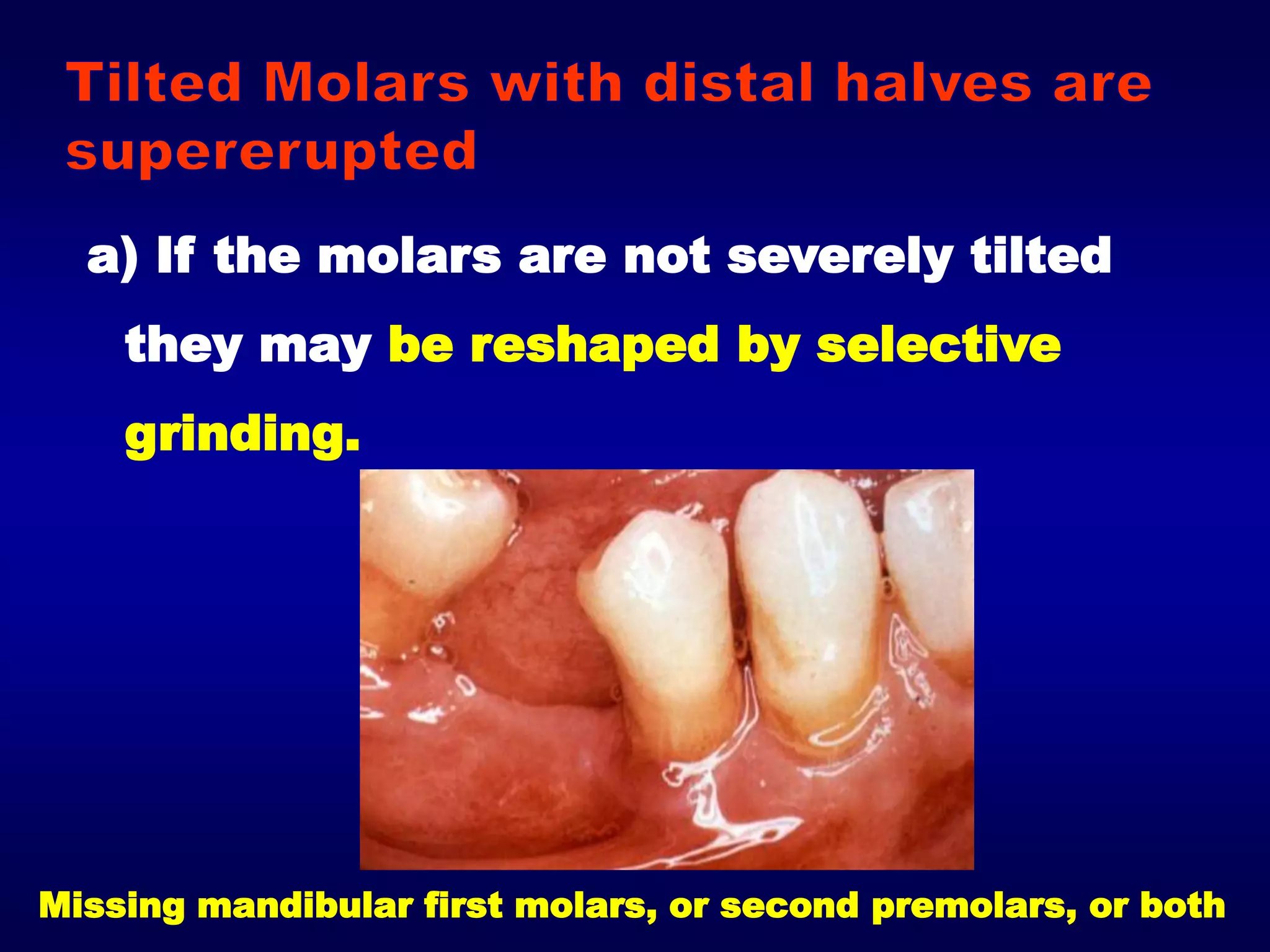 Occlusion of single denture (Management of Maxillary and Mandibular ...