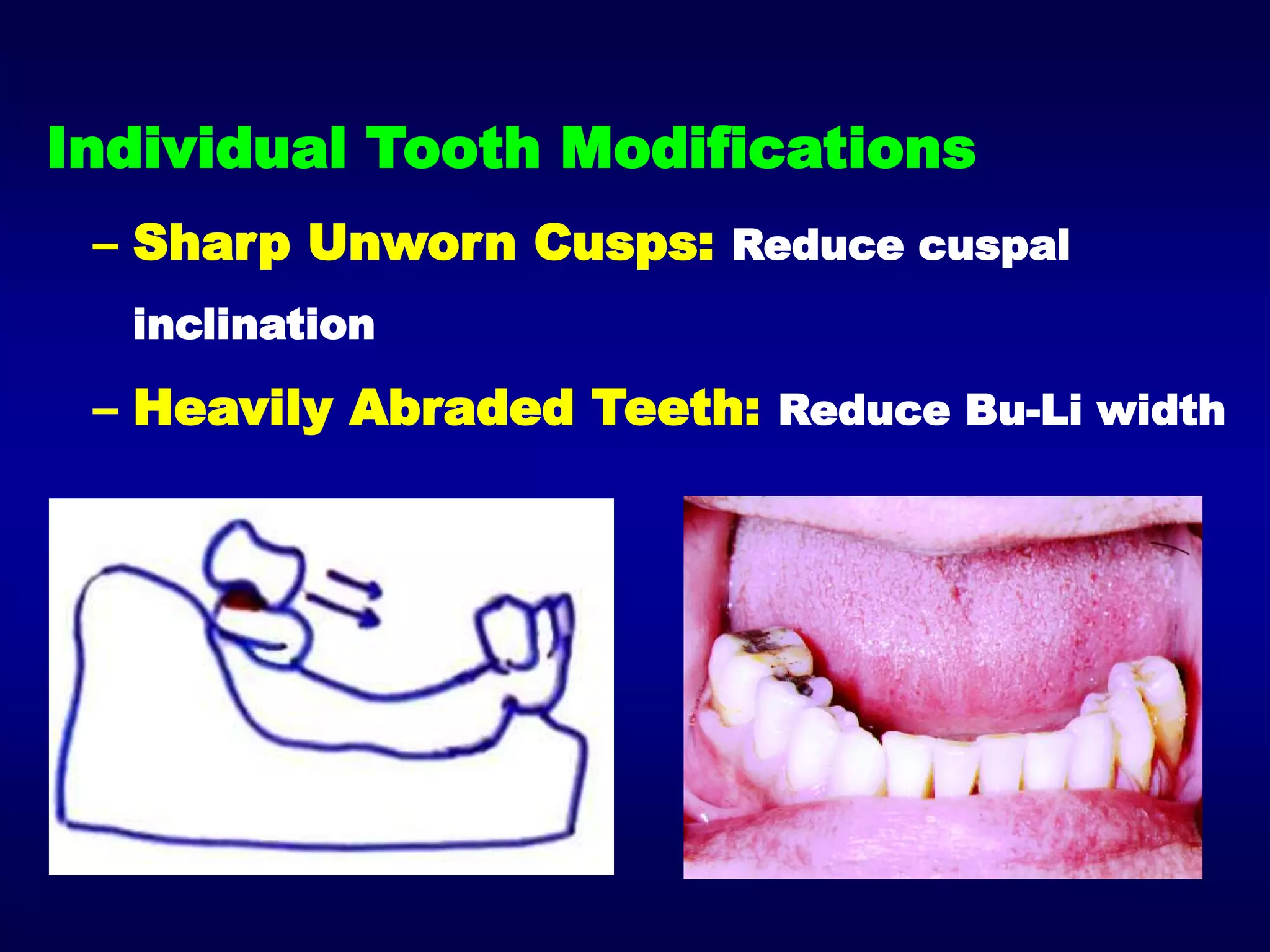 Occlusion of single denture (Management of Maxillary and Mandibular ...