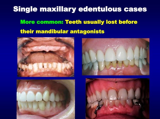 Occlusion of single denture (Management of Maxillary and Mandibular ...