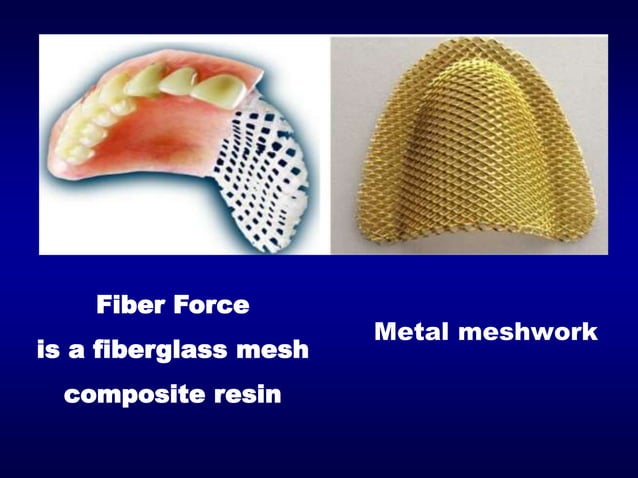Occlusion of single denture (Management of Maxillary and Mandibular ...