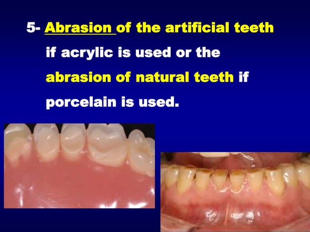 Occlusion of single denture (Management of Maxillary and Mandibular ...