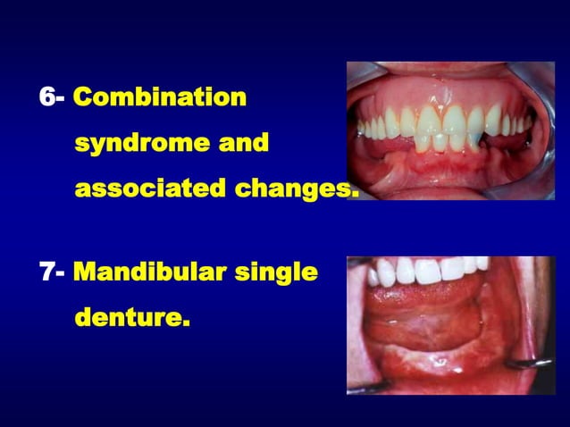 Occlusion of single denture (Management of Maxillary and Mandibular ...