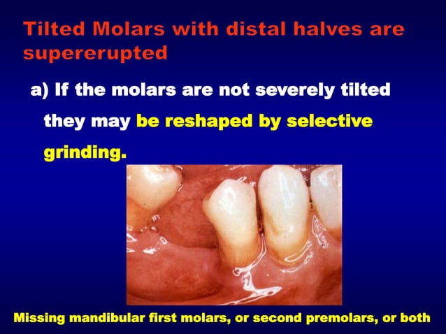 Occlusion of single denture (Management of Maxillary and Mandibular ...