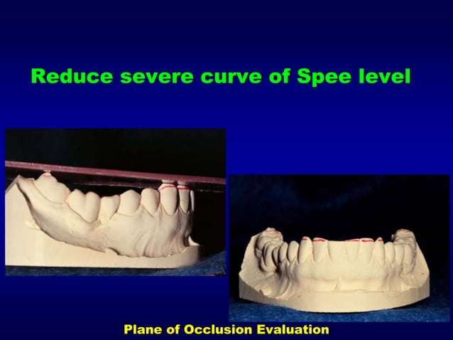Occlusion of single denture (Management of Maxillary and Mandibular ...