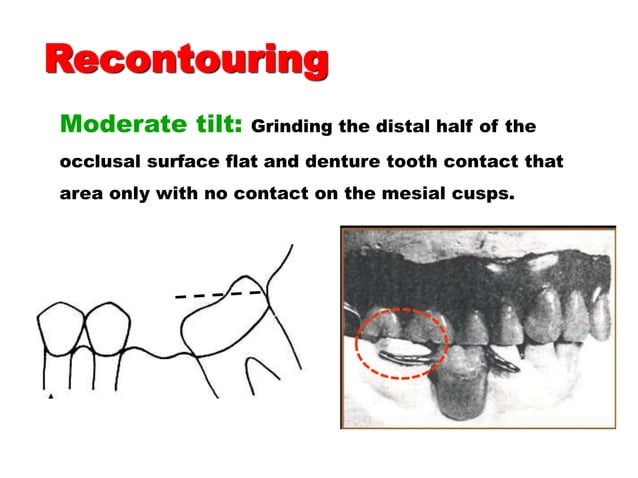 Occlusion of single denture (Management of Maxillary and Mandibular ...