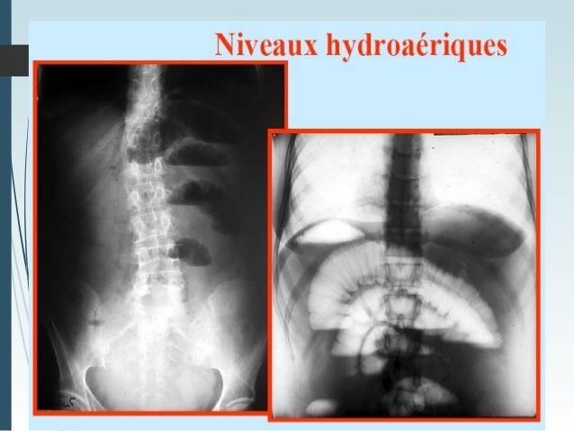 Occlusions intestinales-aiguës