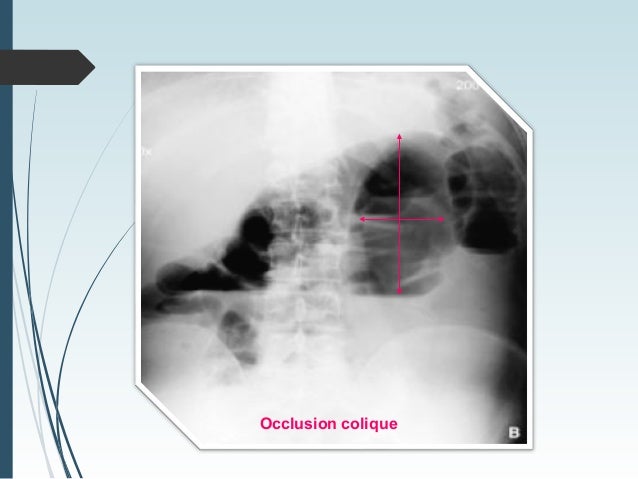Occlusions intestinales-aiguës