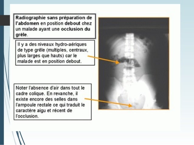 Occlusions intestinales-aiguës