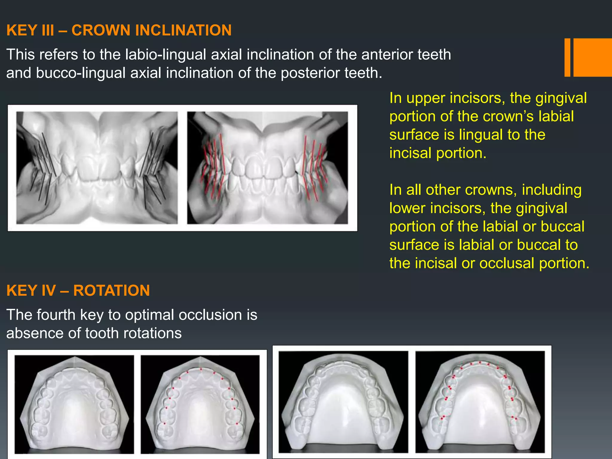 OCCLUSION IN COMPLETE DENTURES | PPTX