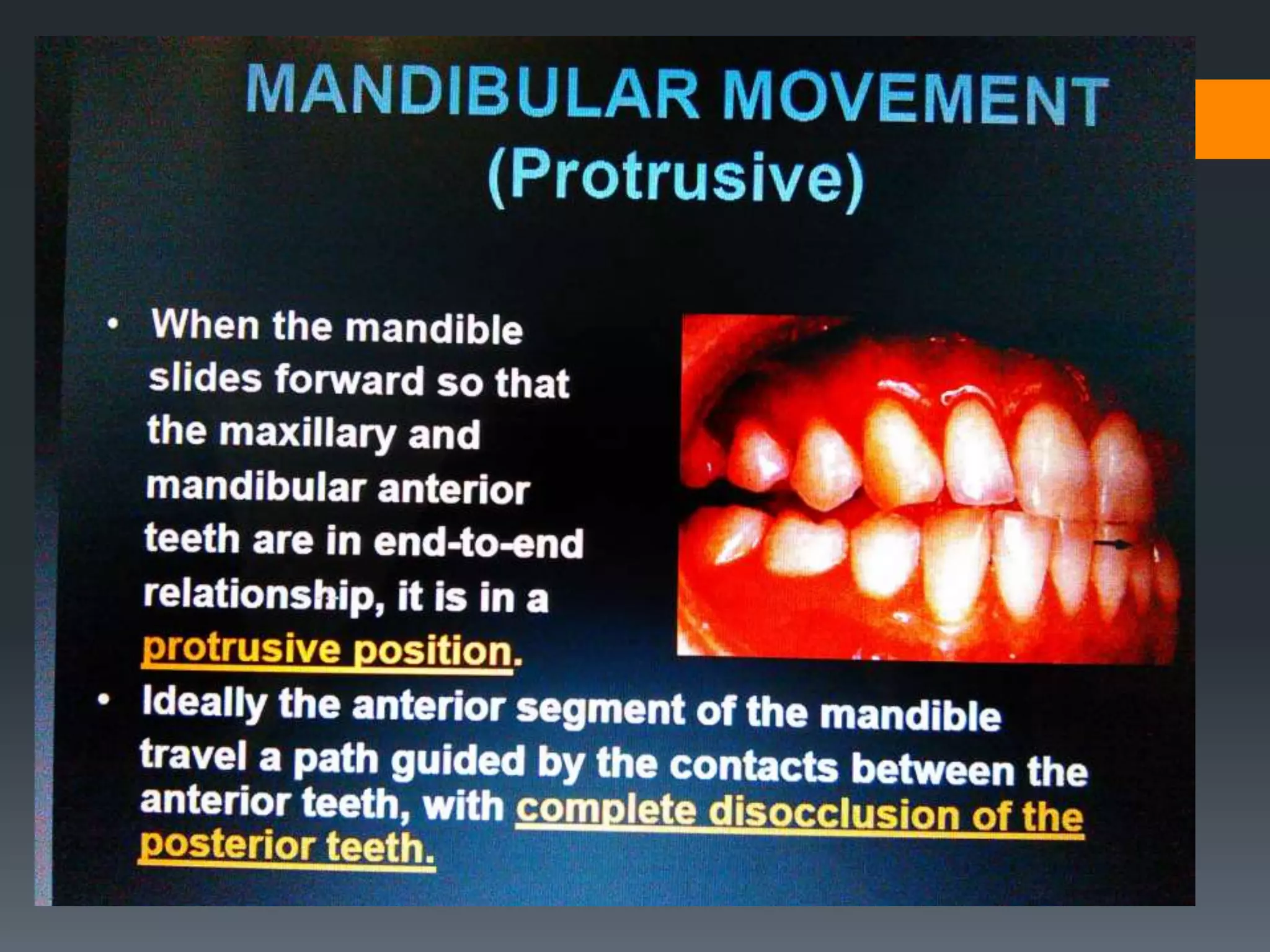 OCCLUSION IN COMPLETE DENTURES | PPTX