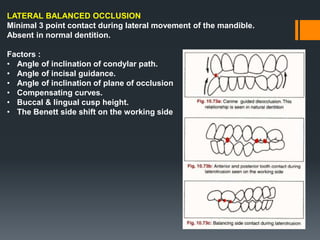 OCCLUSION IN COMPLETE DENTURES | PPTX