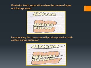 OCCLUSION IN COMPLETE DENTURES | PPTX