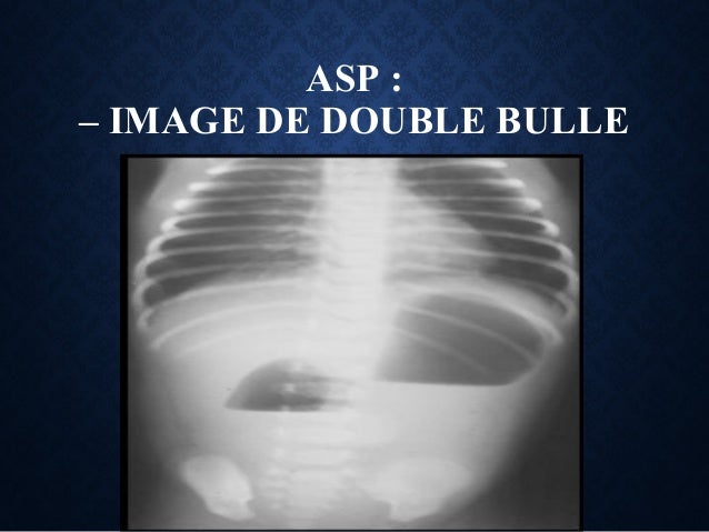 Occlusions neonatales