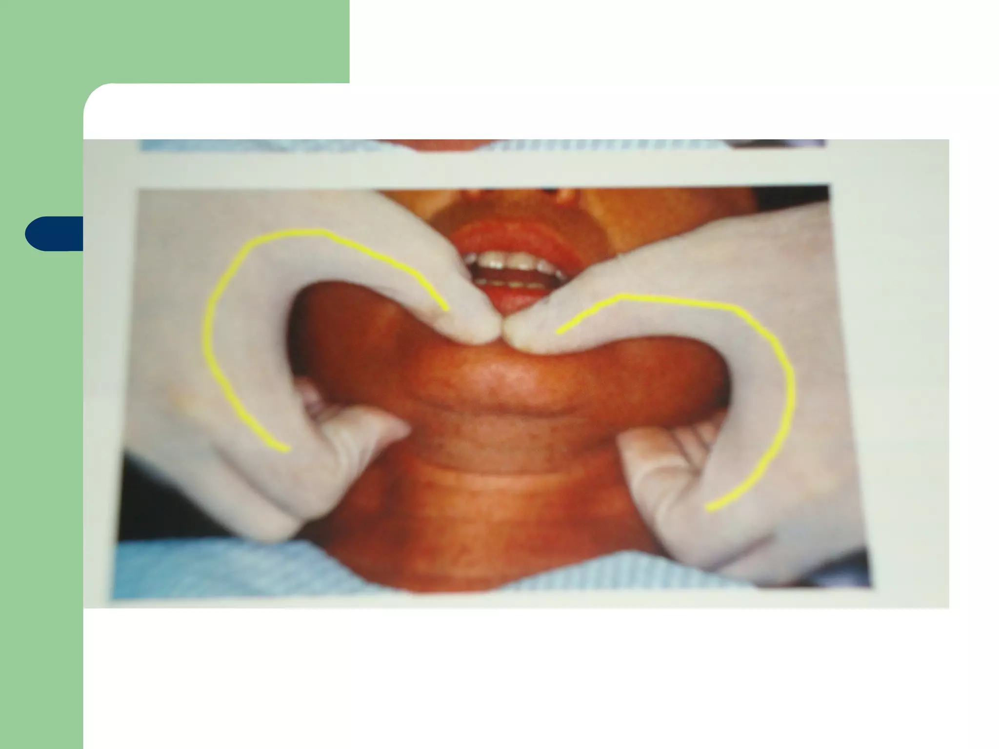 Occluso muscle disorder | PPT