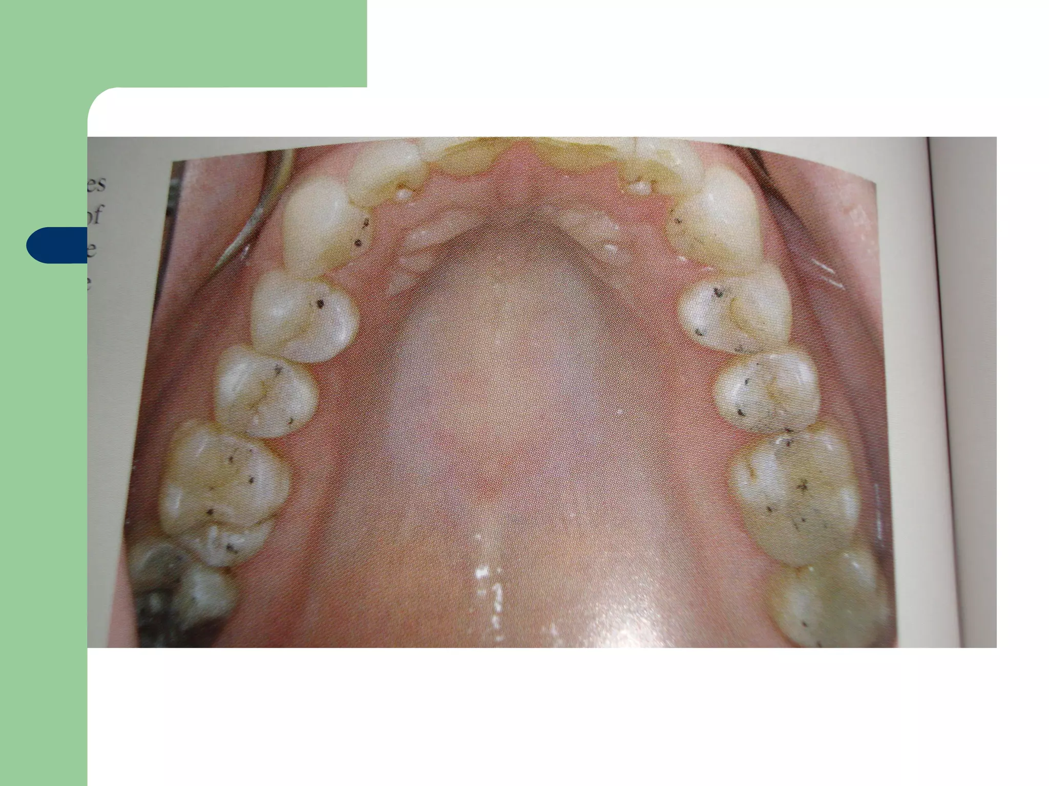 Occluso muscle disorder | PPT