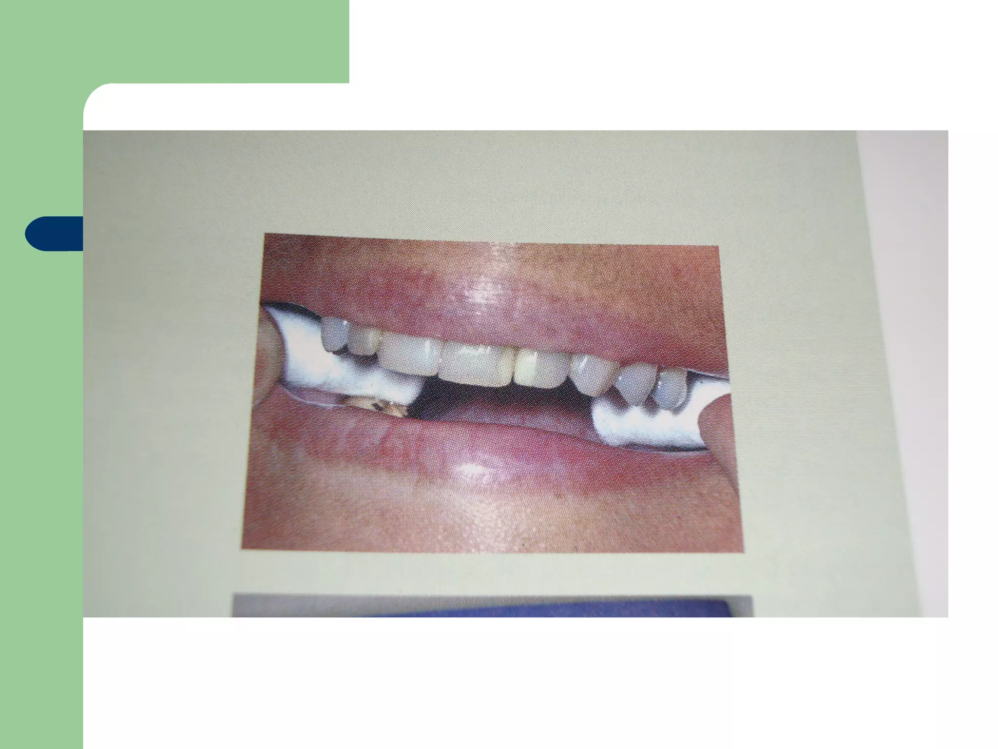 Occluso muscle disorder | PPT