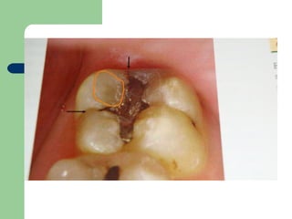 Occluso muscle disorder | PPT