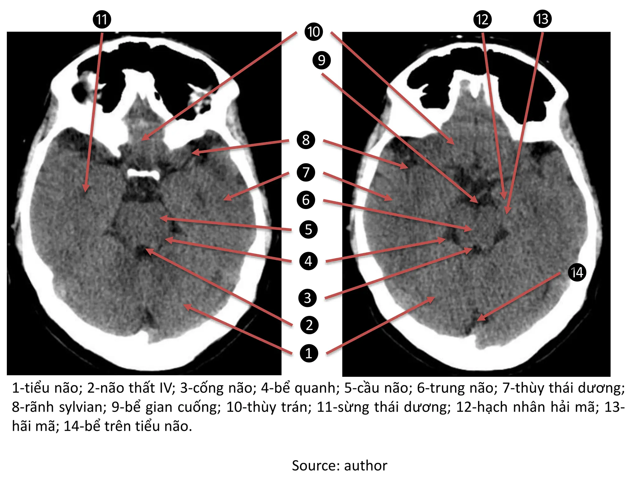 Đọc CLVT sọ não chấn thương - Brain CT-Vietnamese version_new.pptx