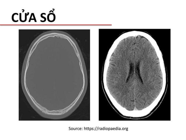 Đọc CLVT sọ não chấn thương - Brain CT-Vietnamese version_new.pptx