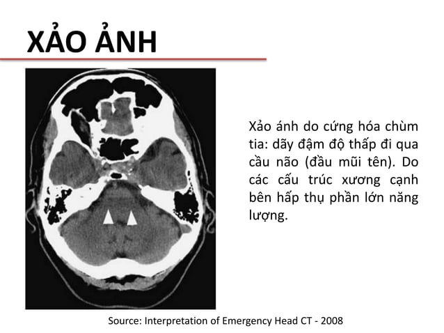Đọc CLVT sọ não chấn thương - Brain CT-Vietnamese version_new.pptx