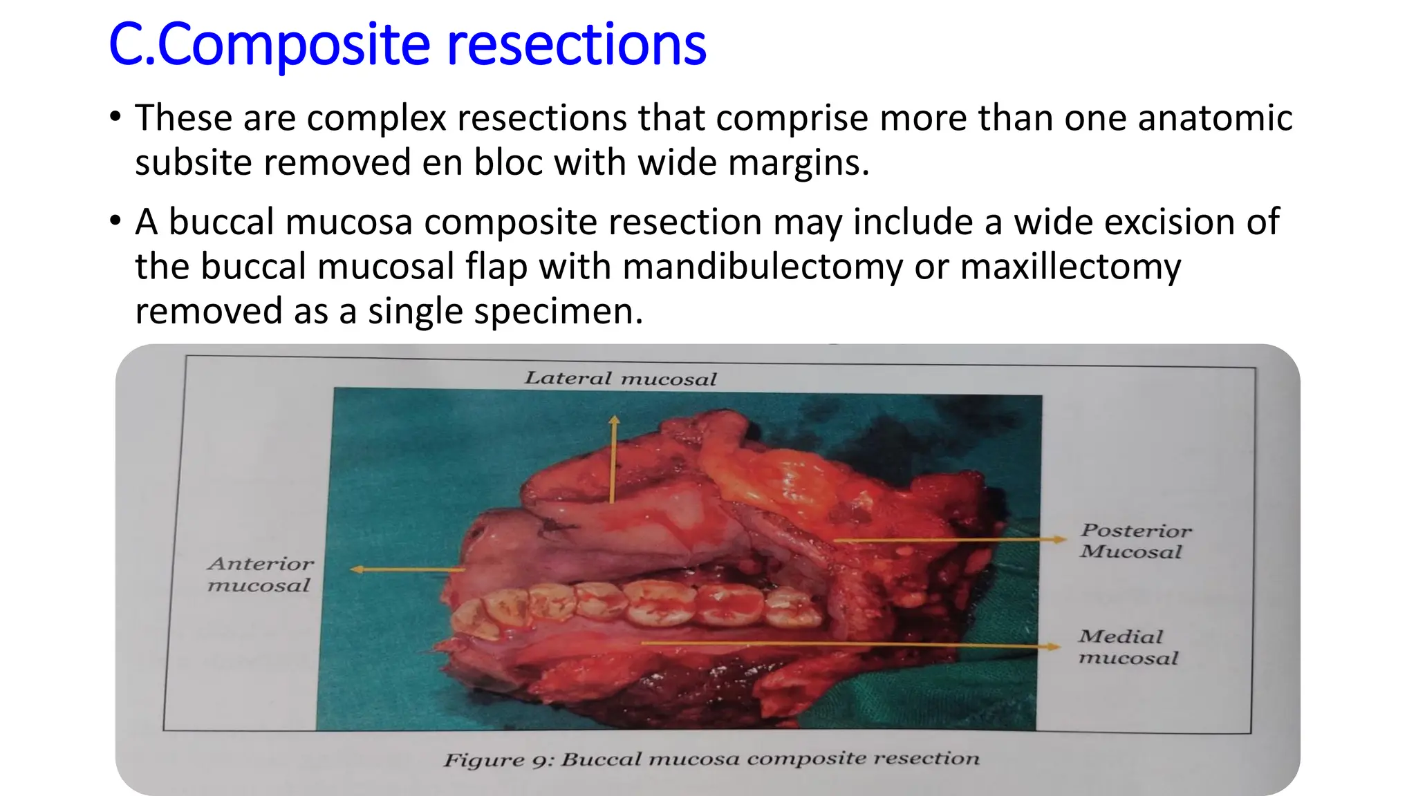 ORAL CAVITY CANCER RESECTIONS:MANDIBULECTOMY & GLOSSECTOMY | PDF