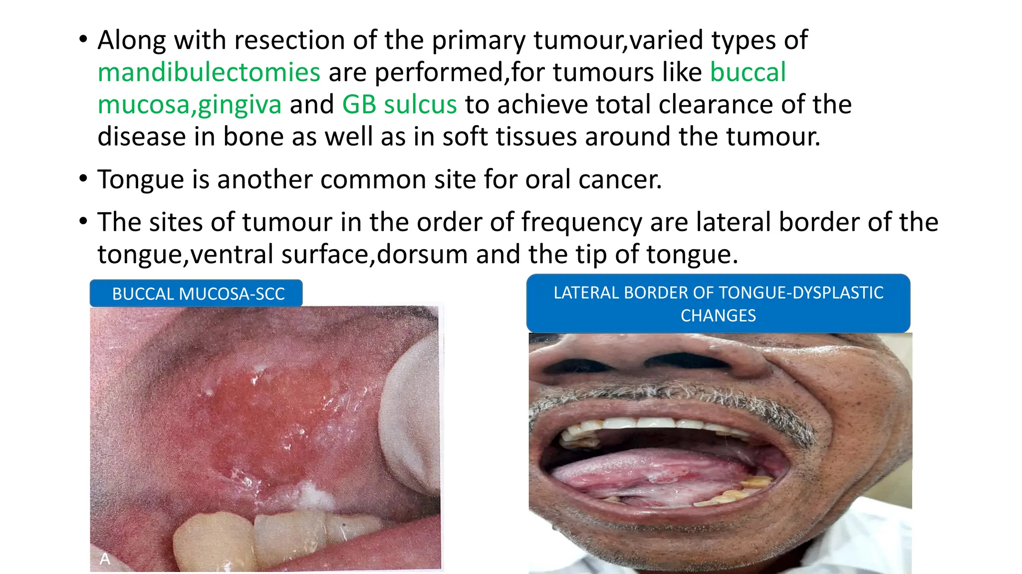 ORAL CAVITY CANCER RESECTIONS:MANDIBULECTOMY & GLOSSECTOMY | PDF
