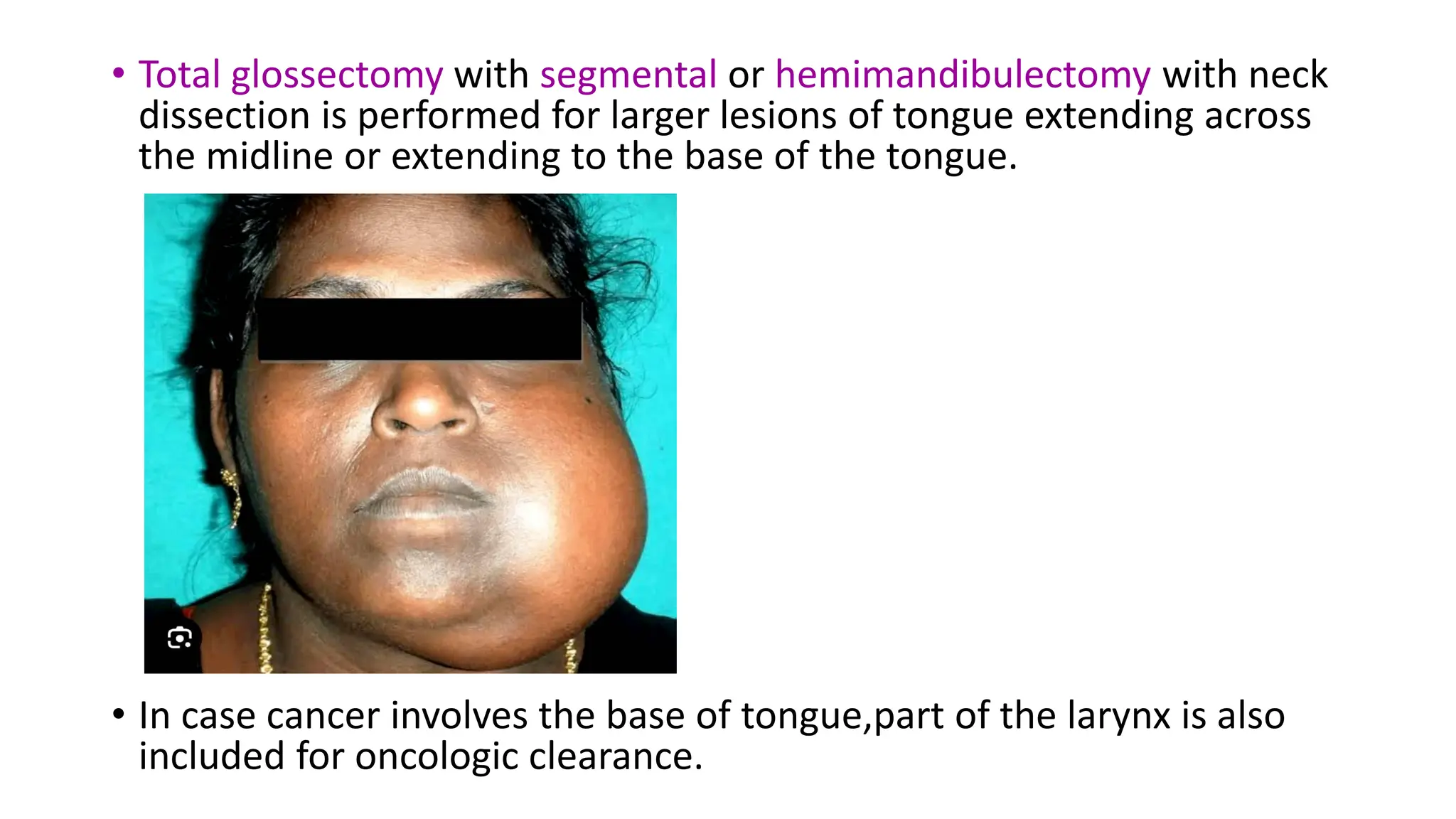 ORAL CAVITY CANCER RESECTIONS:MANDIBULECTOMY & GLOSSECTOMY | PDF