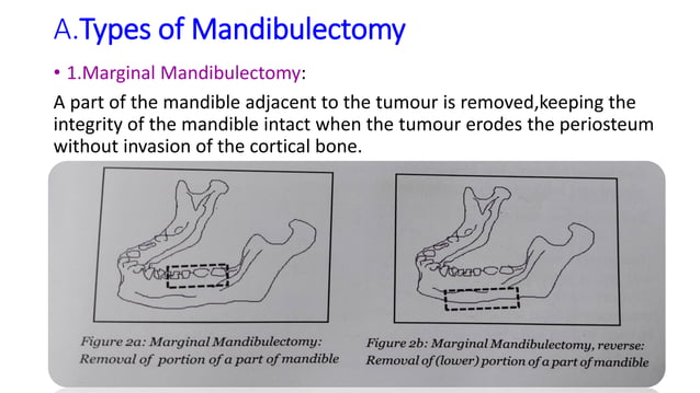 ORAL CAVITY CANCER RESECTIONS:MANDIBULECTOMY & GLOSSECTOMY | PDF